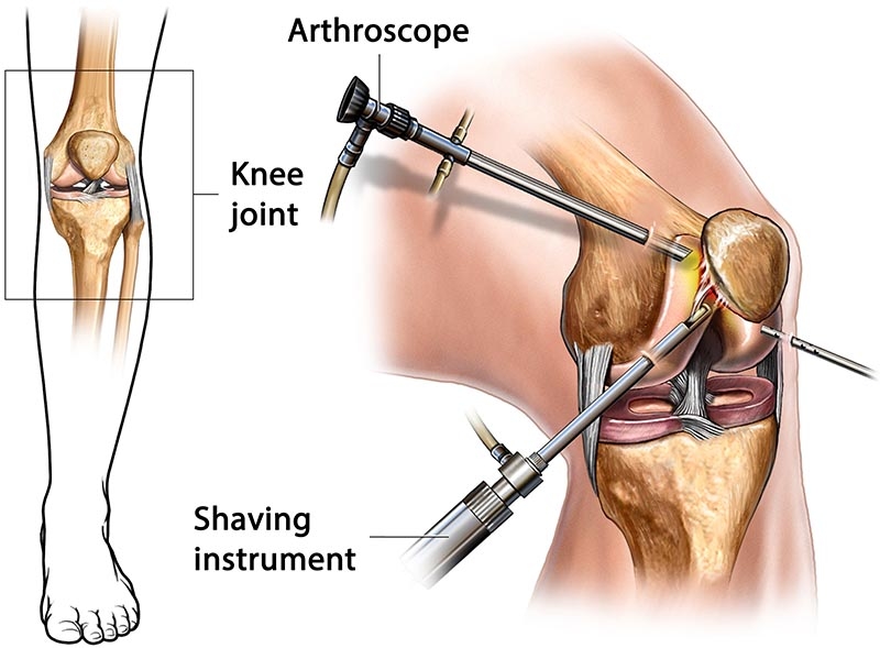 Arthroscopy Healthdirect Arthroscopy Healthdirect