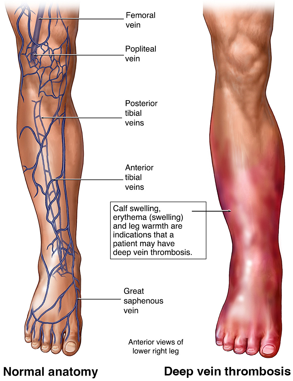 Varicose Vein Blood Clot Varicose Veins Treatment In Tampa Expert Varicose Vein Blood Clot Varicose Veins Treatment In Tampa Expert