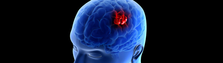 Brain tumours | healthdirect