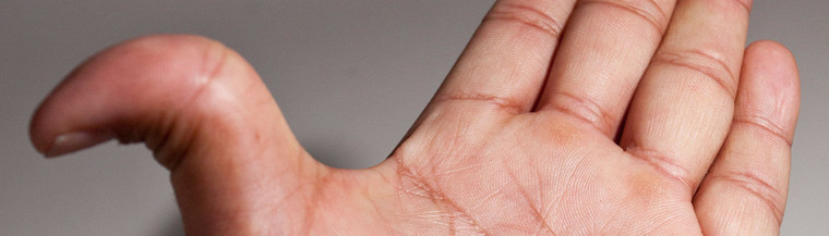 Ehlers-Danlos syndrome | healthdirect