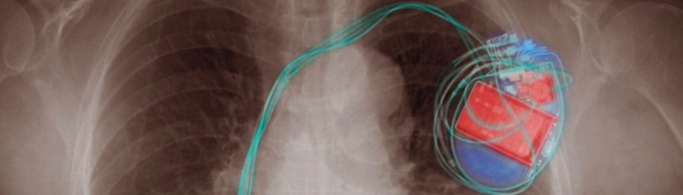 Pacemaker | healthdirect