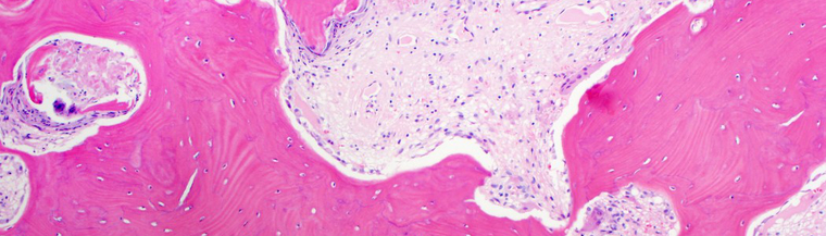 Paget's disease of bone - symptoms, treatments and causes | healthdirect