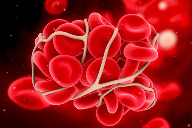 Angiogram | healthdirect