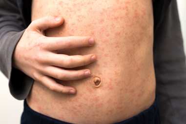 What does measles rash look like? | healthdirect
