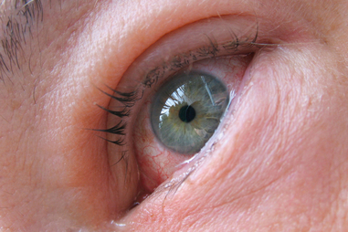 Trachoma | healthdirect