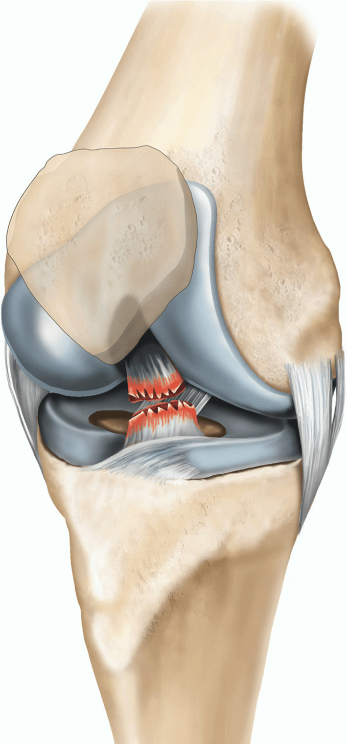 ACL Reconstruction Healthdirect ACL Reconstruction Healthdirect