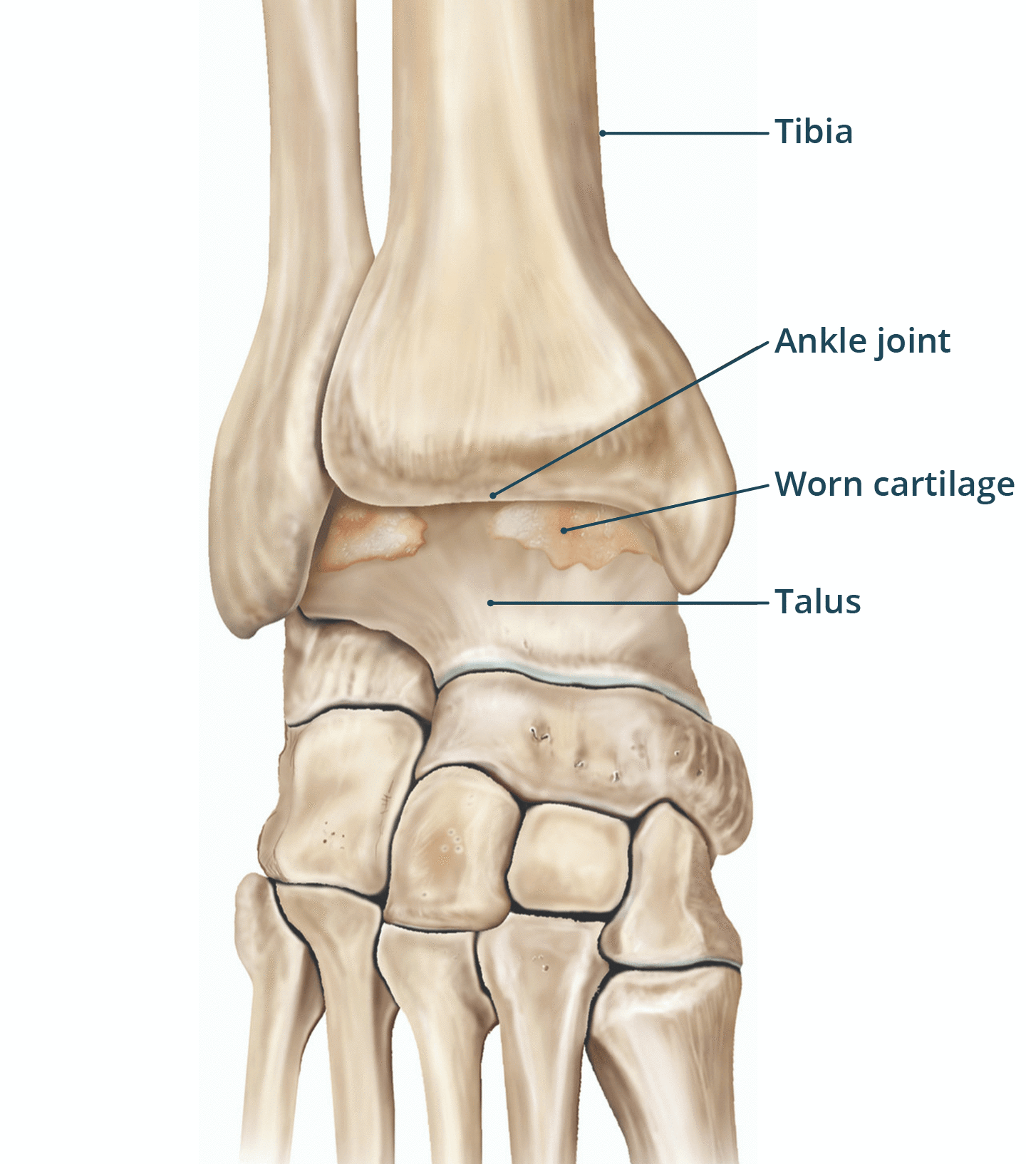 Ankle Joint System Ankle Joints | FIOR & GENTZ