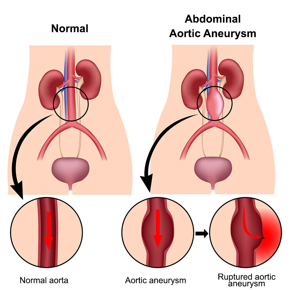 Stomach Aorta