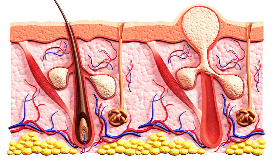 What Causes Boils On Buttocks How To Get The Core Out Of A Boil What