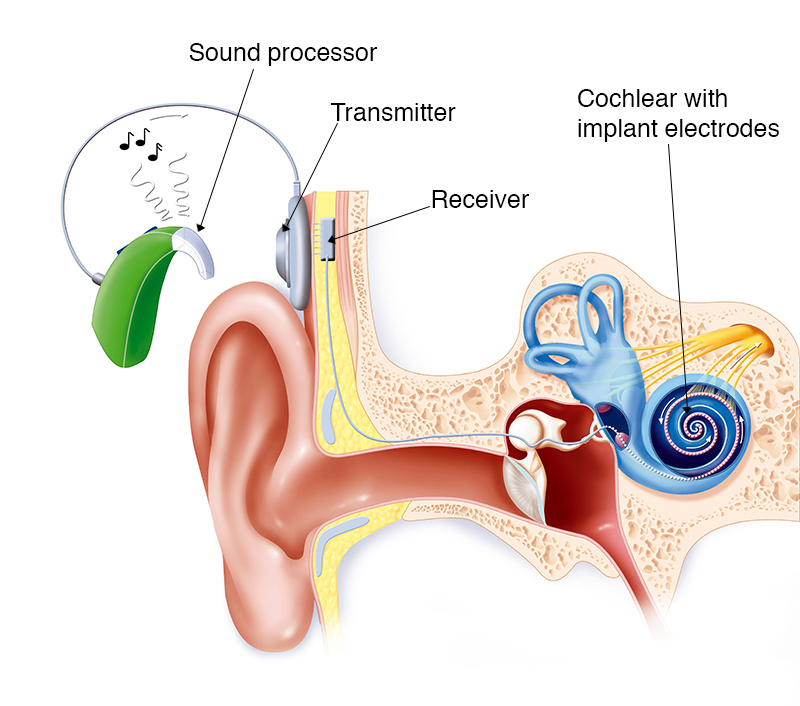 Cochlear Implant Healthdirect Cochlear Implant Healthdirect