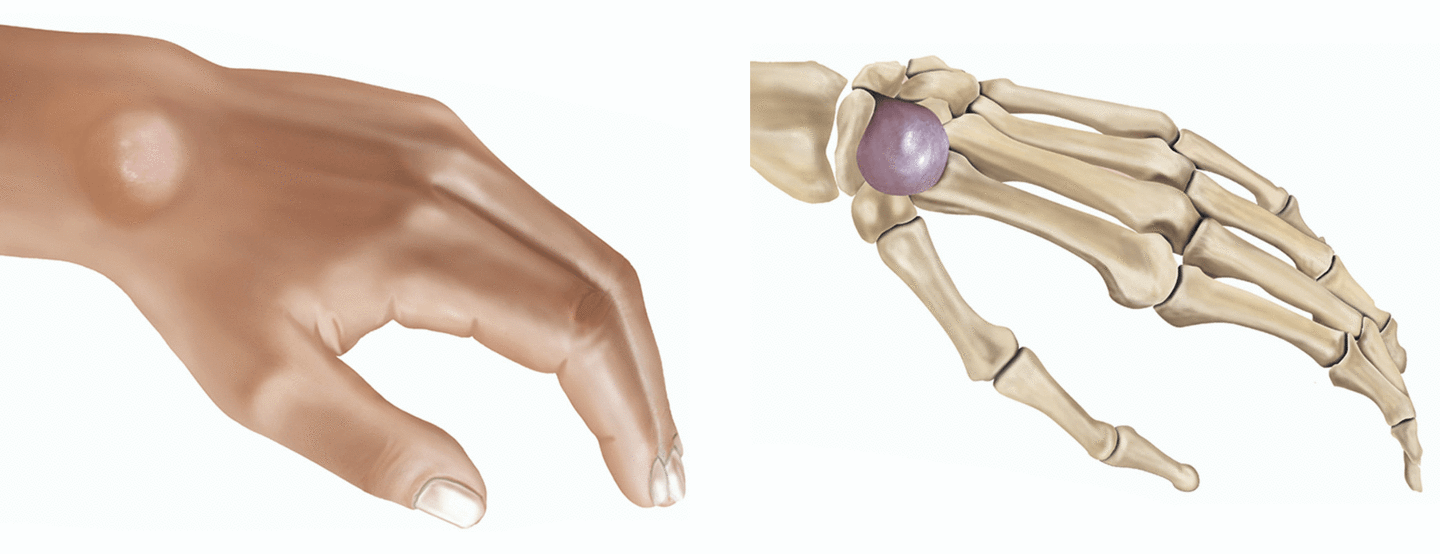 Ganglion Cyst Removal