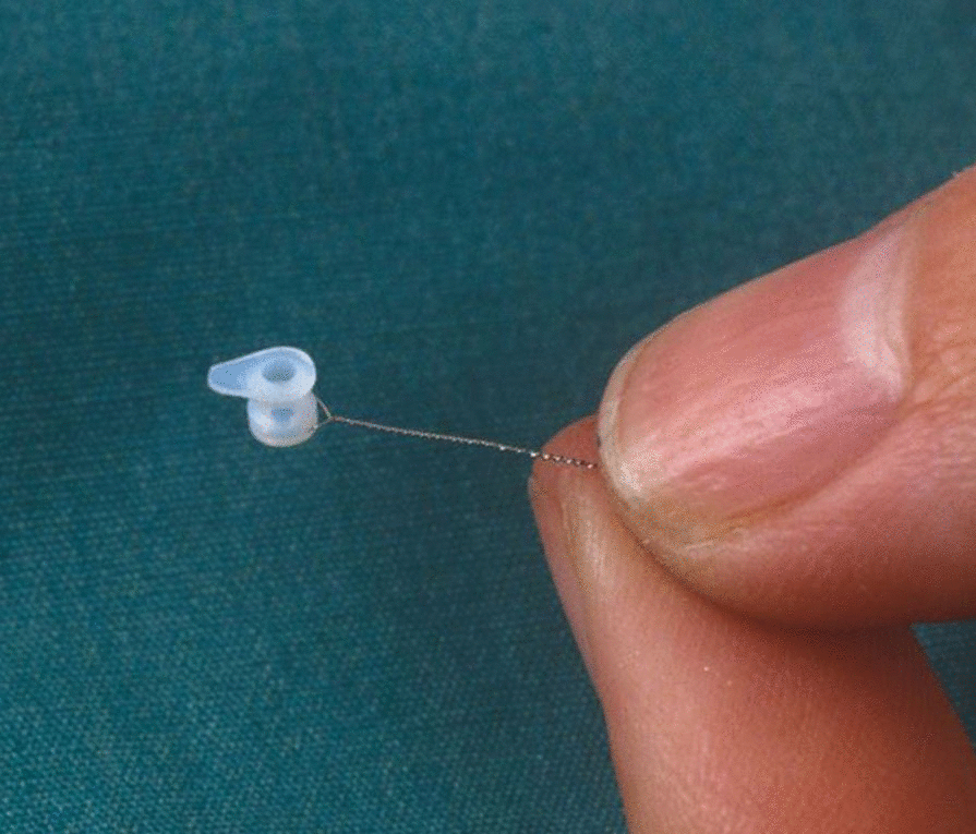 Grommet Surgery For Adults Grommets Tolbecs Ear Centre XXASM Grommet Surgery For Adults Grommets Tolbecs Ear Centre XXASM