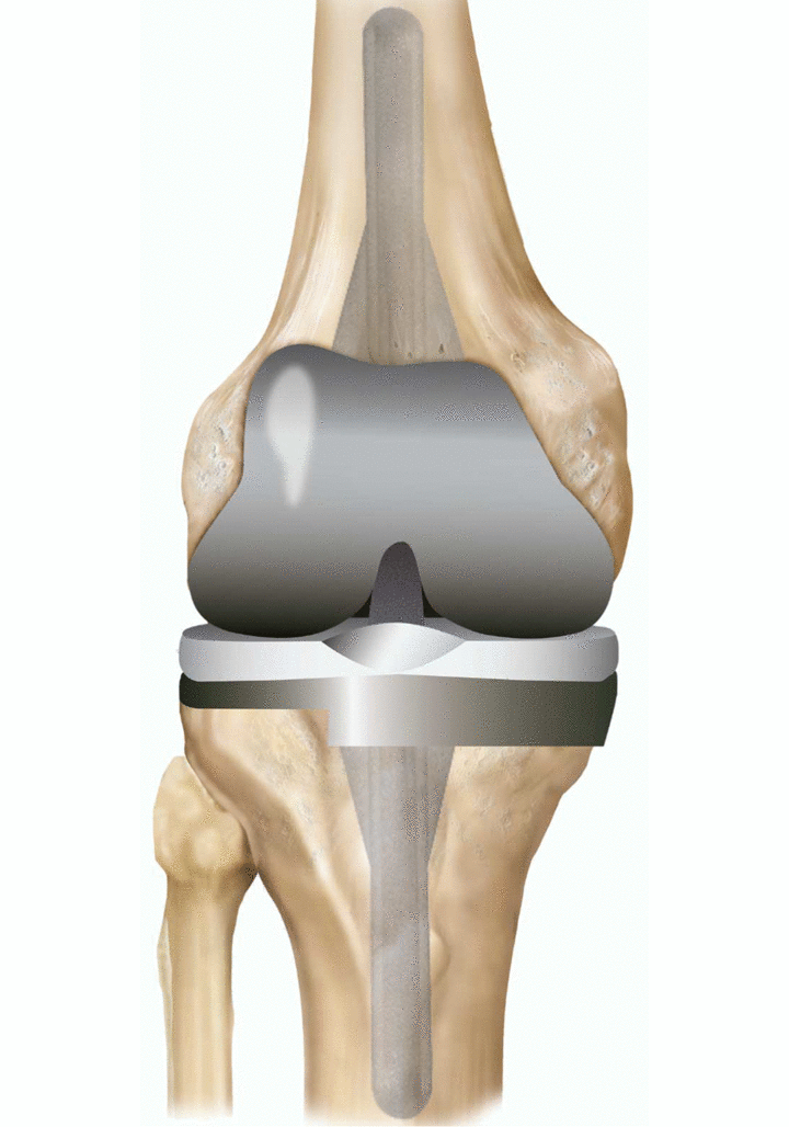 Total Knee Replacement Total Knee Replacement New Iberia, LA