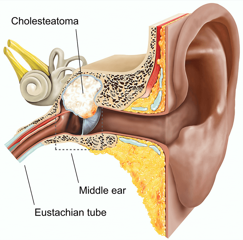 Surgery For Cholesteatoma Healthdirect Surgery For Cholesteatoma Healthdirect