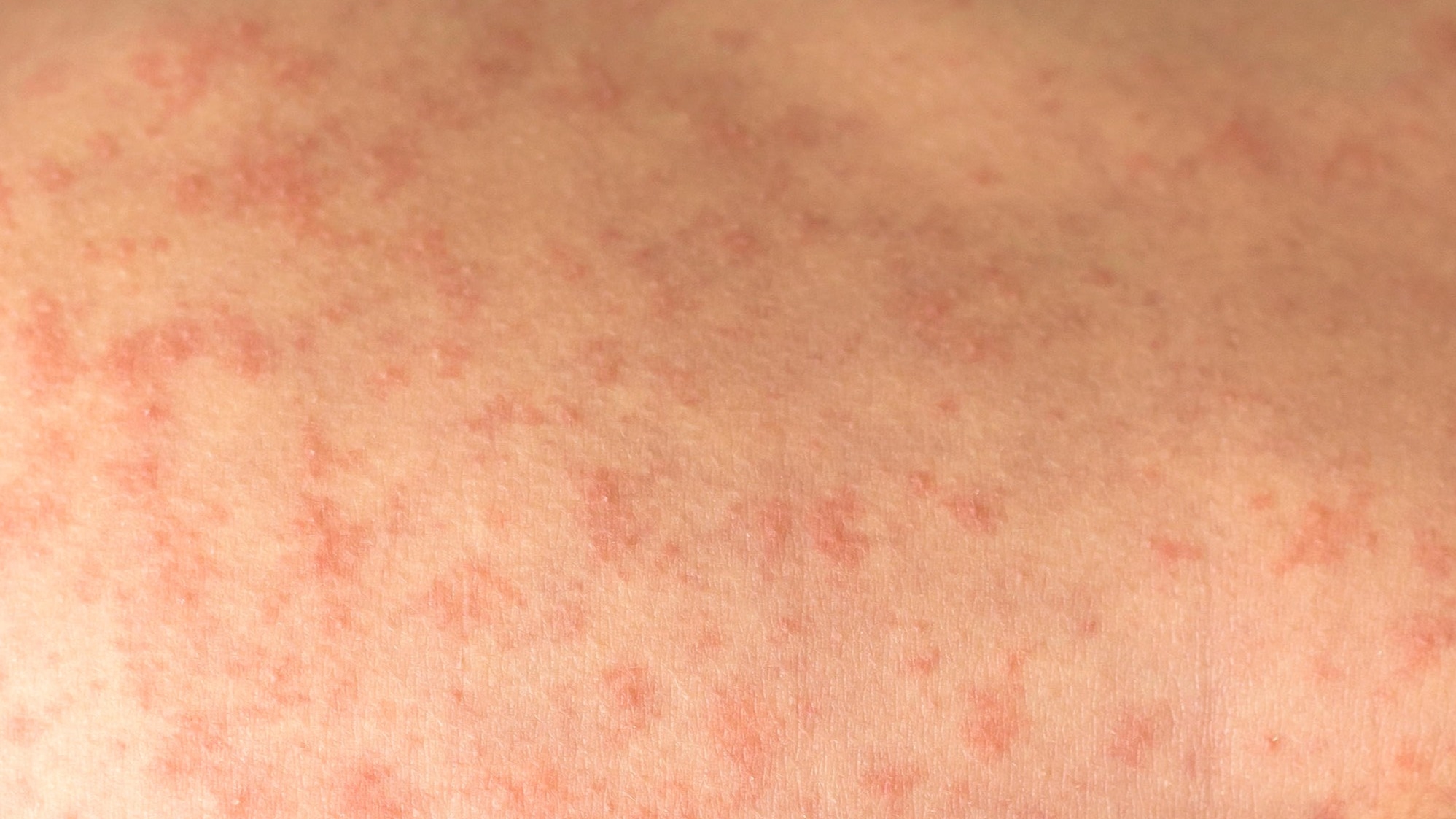 What Does Measles Rash Look Like Healthdirect What Does Measles Rash Look Like Healthdirect